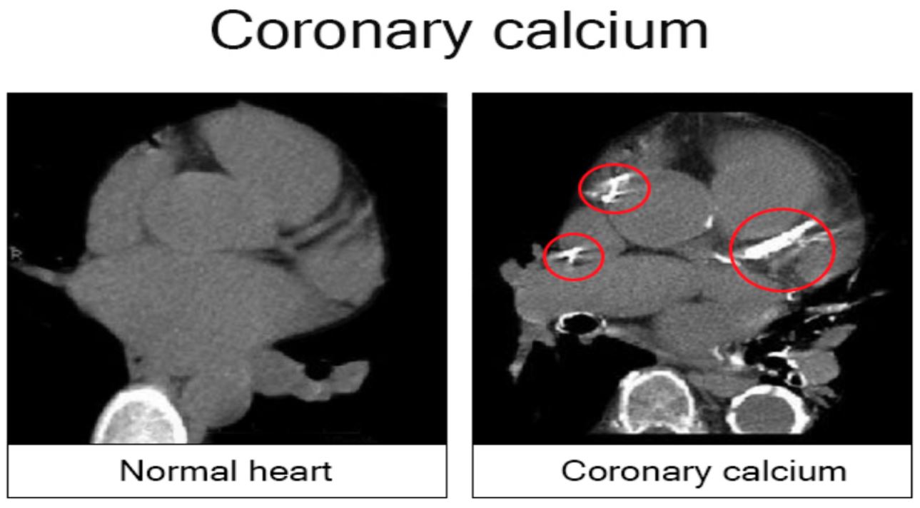 Cardiovascular Disease Uncovered – Coronary Calcium Scan | Regenerative ...