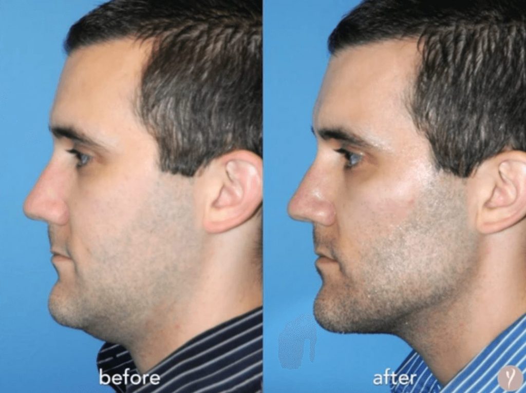 Y LIFT Pittsburgh Pittsburgh | Regenerative Medicine Center - Dr ...